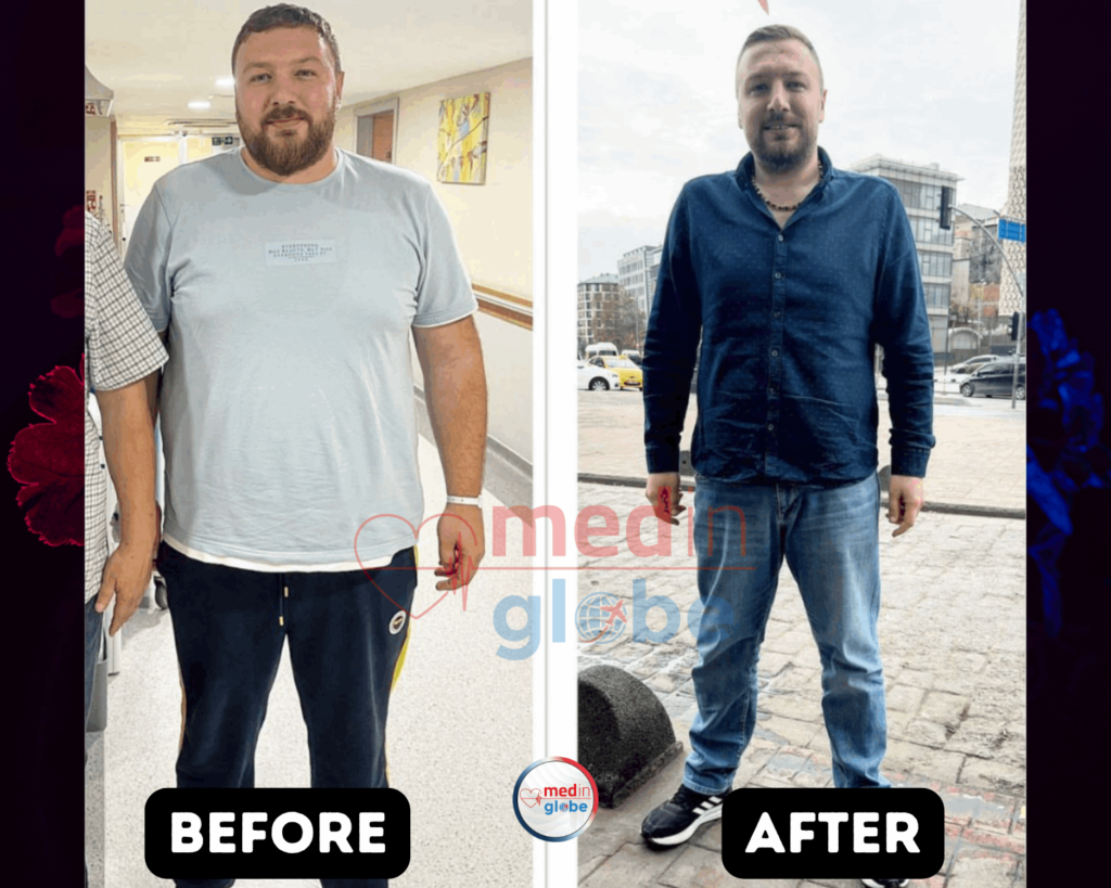 Obesity Surgery - All Bariatric Surgeries in Istanbul Turkey